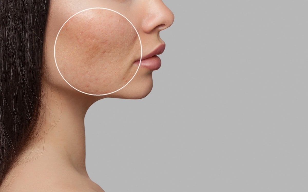 Acne Scar Treatment Treatment in North Dallas | North Dallas ...